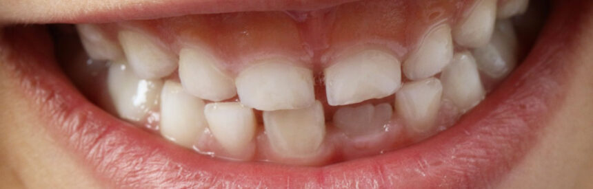 Baby Tooth Extraction – Experteeth Dental Group 益白齿科 www.experteeth.com.au